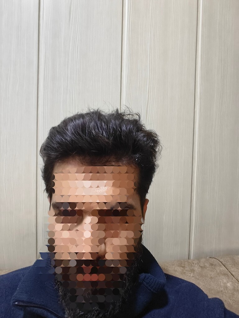 How iam doing iam receding male 28 - General - Tressless Community