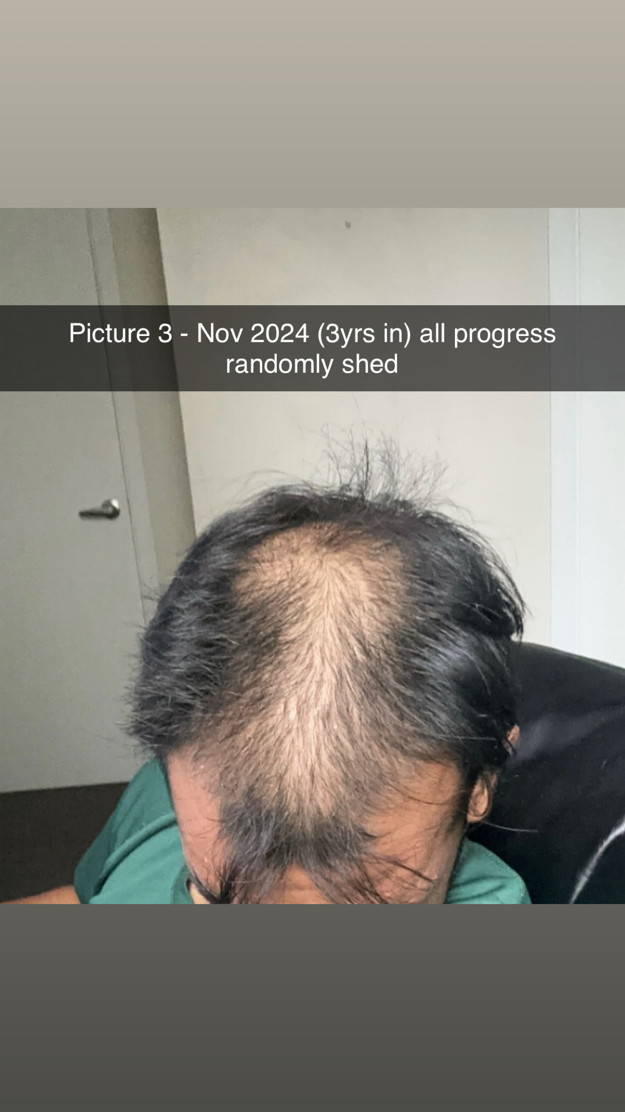 24M: Lack of Progress After 4 Years on Fin/Min/Keto and Recent Shed ...