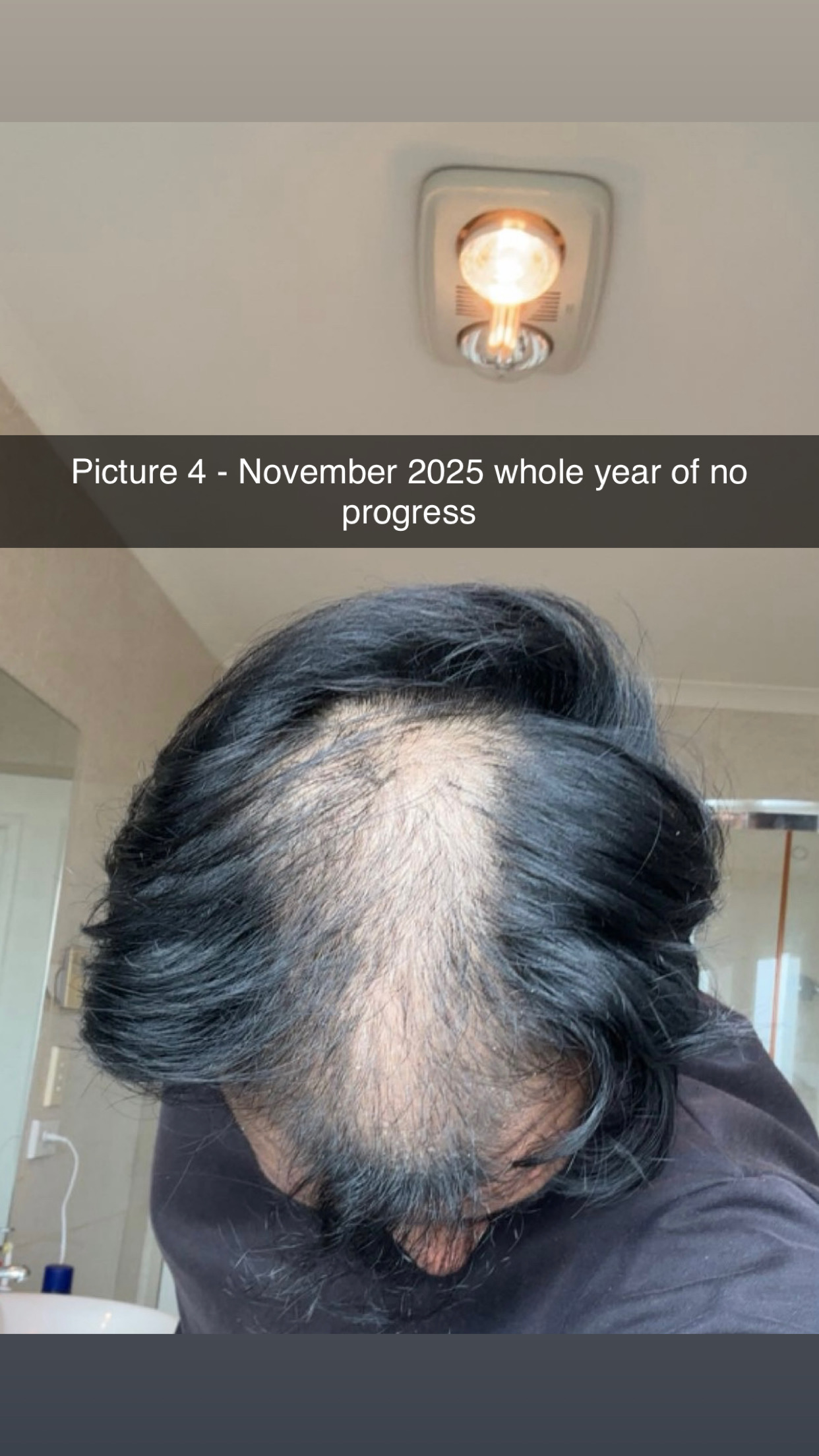 24M: Lack of Progress After 4 Years on Fin/Min/Keto and Recent Shed ...