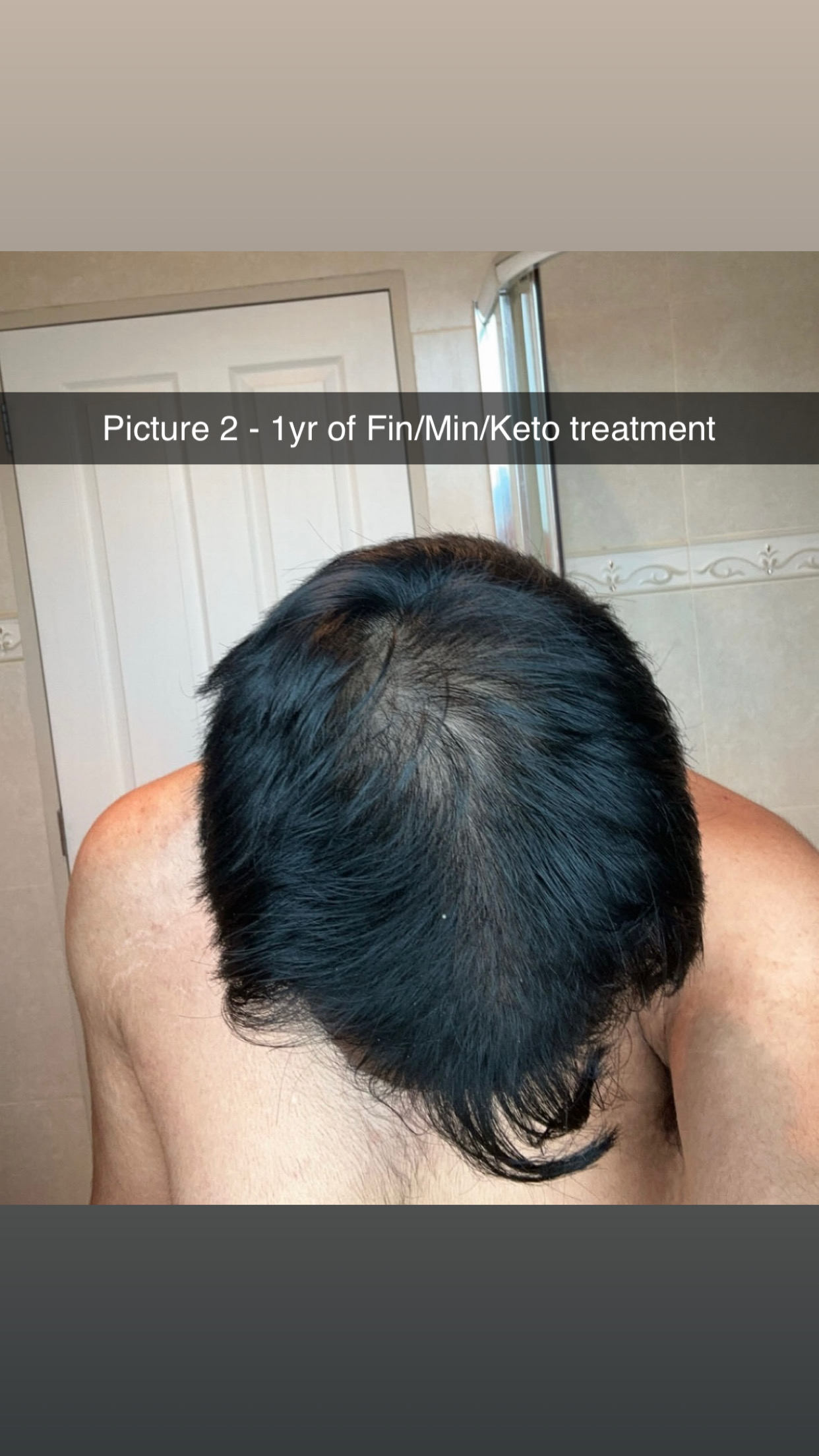 24M: Lack of Progress After 4 Years on Fin/Min/Keto and Recent Shed ...