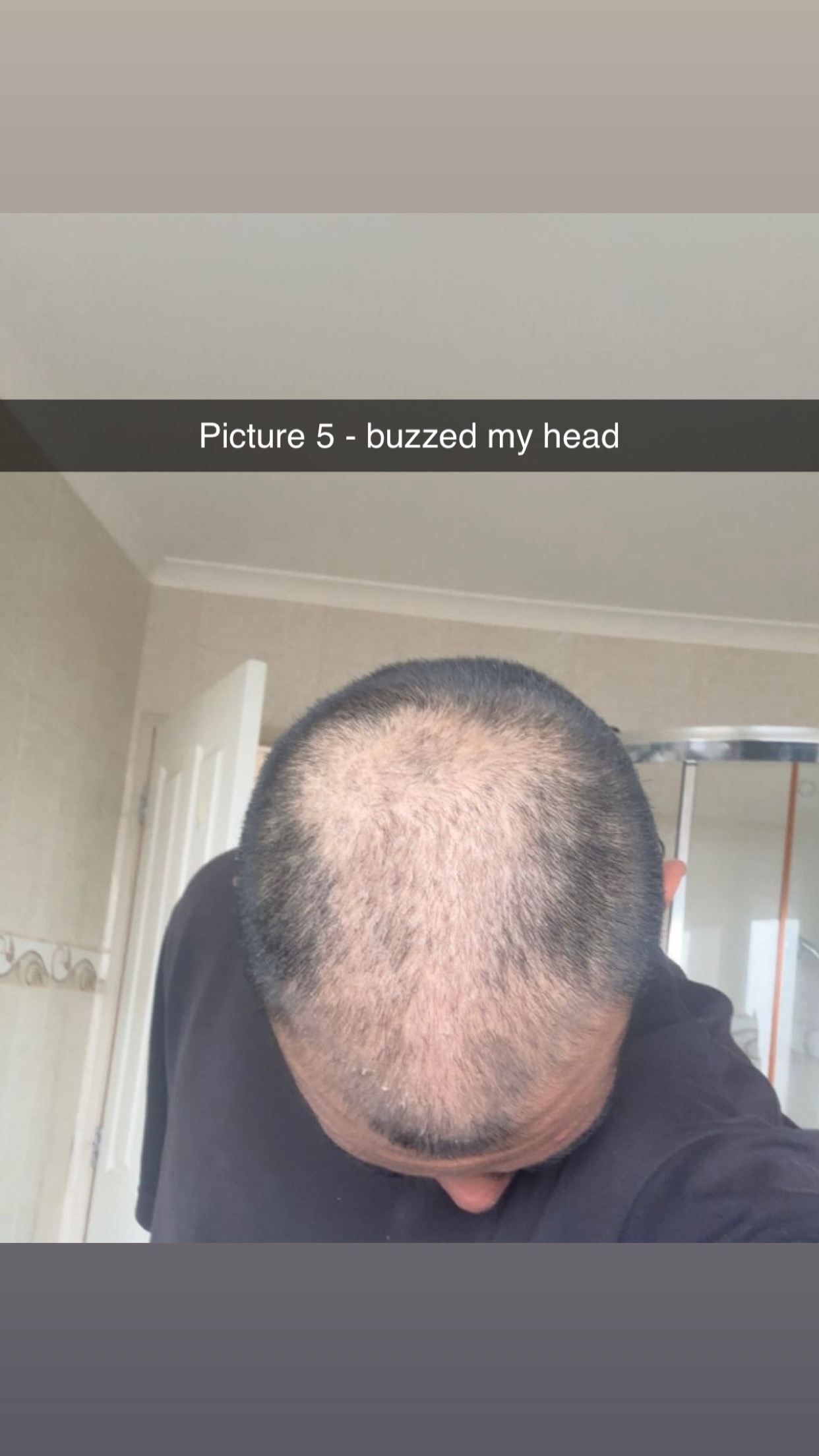 24M: Lack of Progress After 4 Years on Fin/Min/Keto and Recent Shed ...